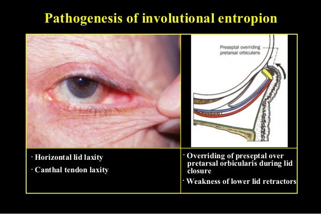 ectropion & entropion