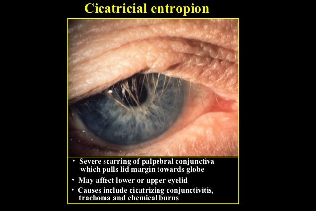ectropion & entropion