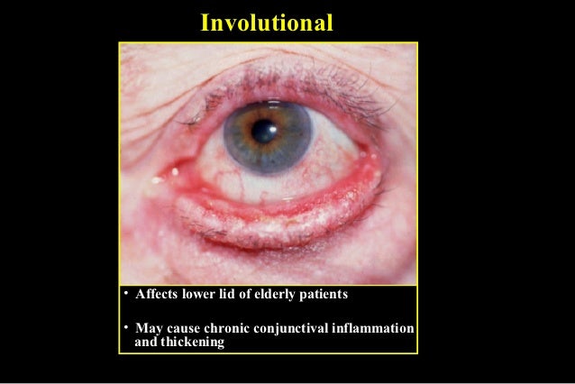 Involutional Entropion