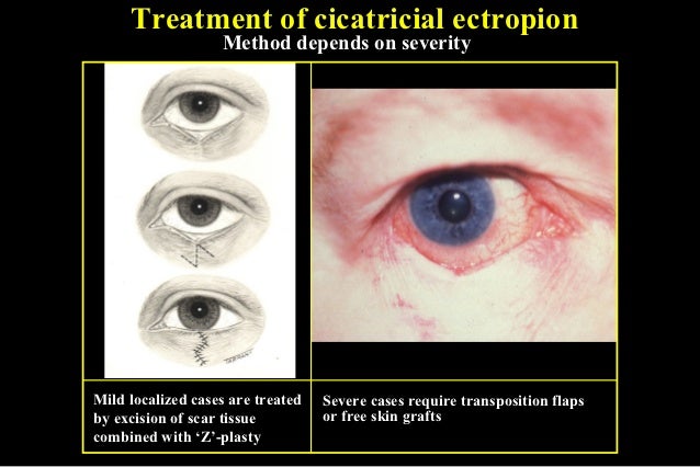 Entropion And Ectropion Causes Symptoms And Treatment Entropion And