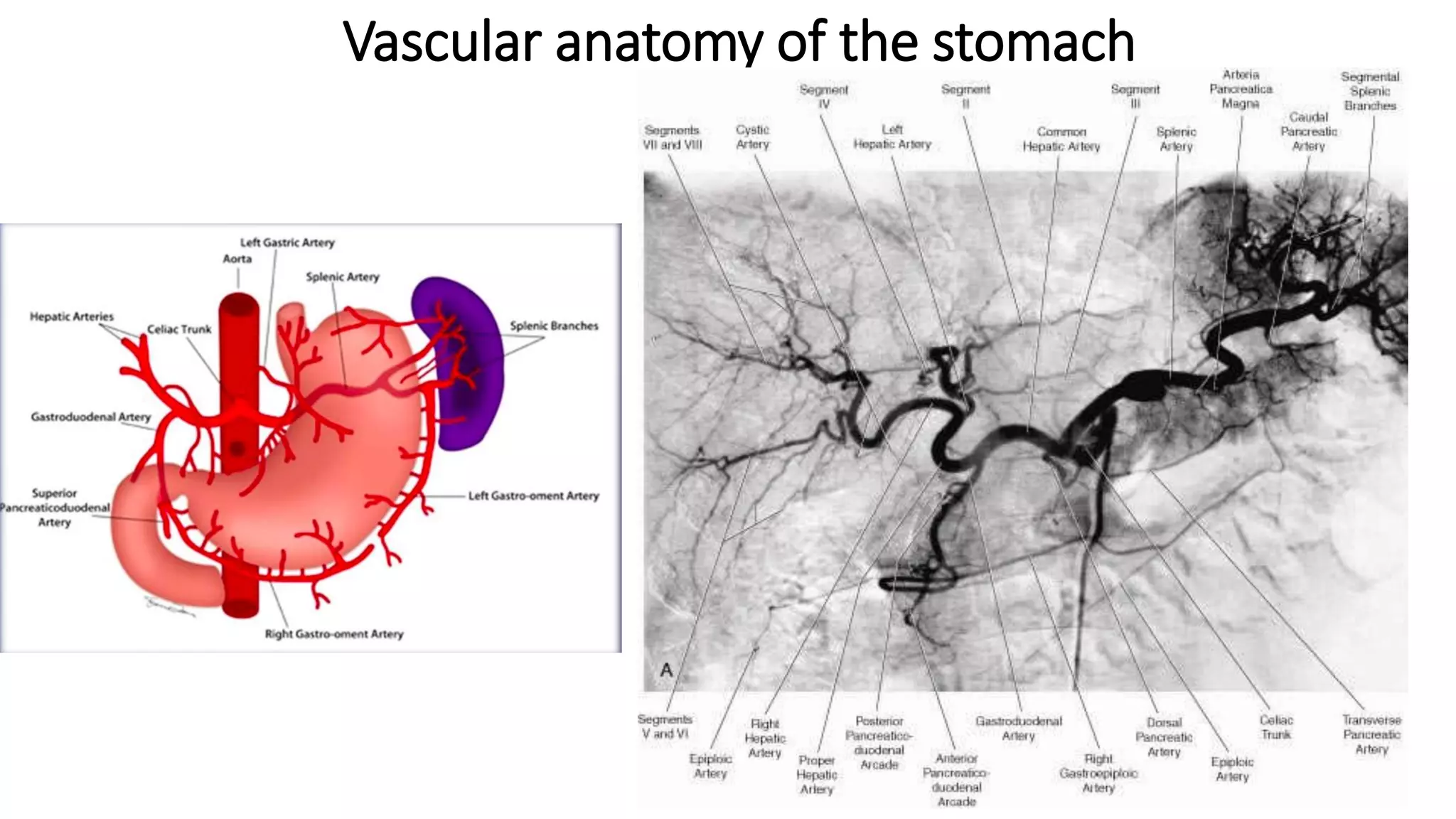 06 endovascular Ruzsa aimradial20170921 Gastric embolization | PPT