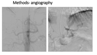 06 endovascular Ruzsa aimradial20170921 Gastric embolization | PPT