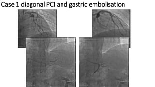 06 endovascular Ruzsa aimradial20170921 Gastric embolization | PPT
