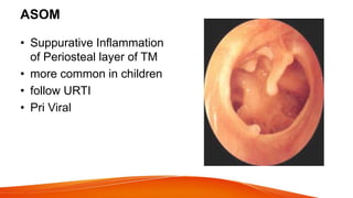 OTITIS MEDIA | PPT