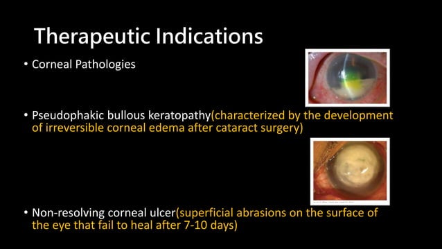 06 Indications & Contra Indications of Contact Lenses.pptx
