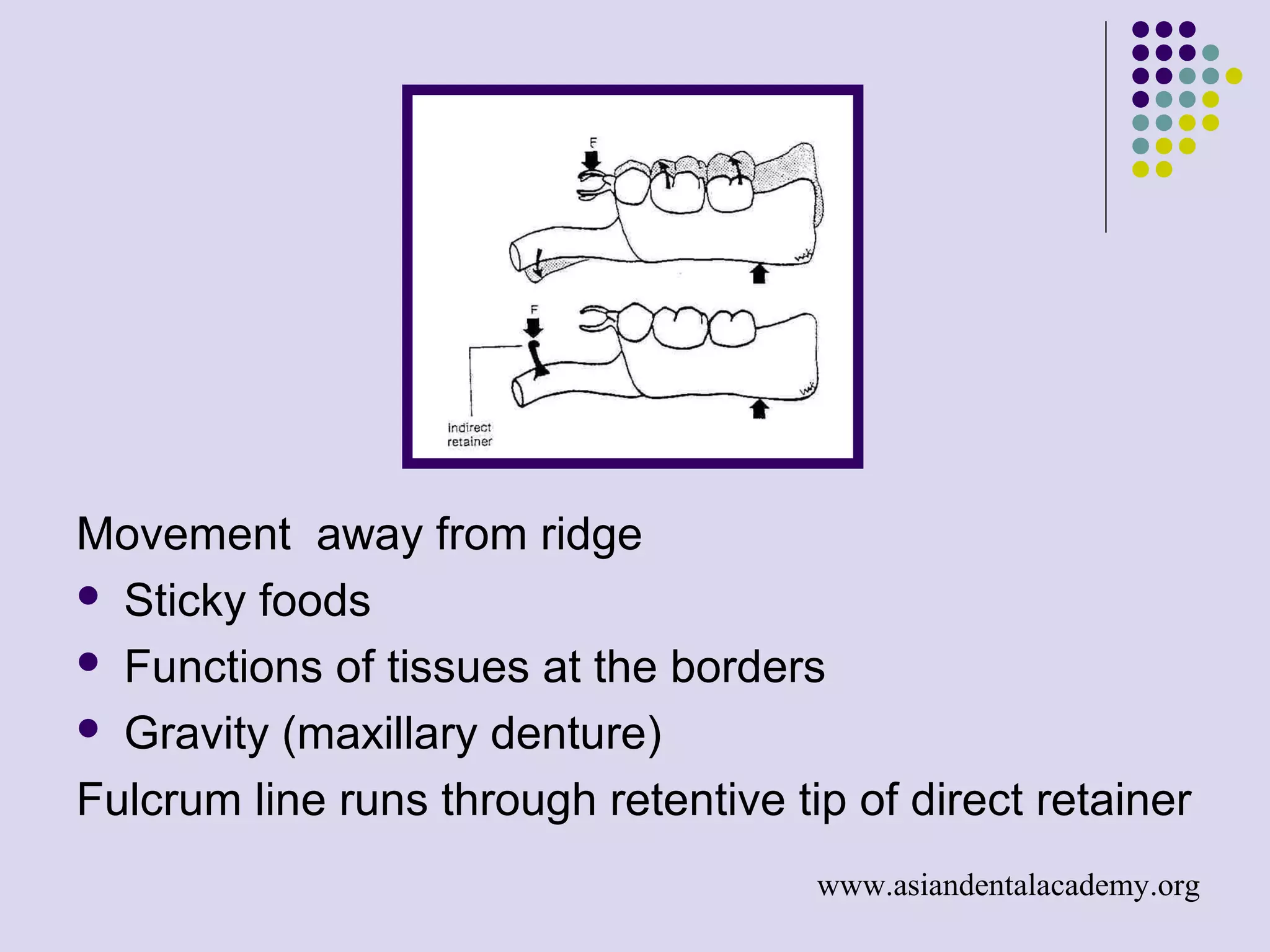 indirect retainers for Removable Partial Dentures | PPT
