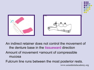 indirect retainers for Removable Partial Dentures | PPT | Dental Health ...