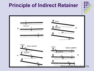 indirect retainers for Removable Partial Dentures | PPT | Dental Health ...