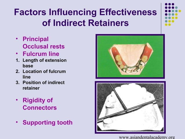 indirect retainers for Removable Partial Dentures | PPT | Dental Health ...