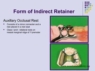 indirect retainers for Removable Partial Dentures | PPT | Dental Health ...