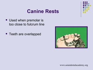 indirect retainers for Removable Partial Dentures | PPT