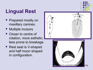 indirect retainers for Removable Partial Dentures | PPT