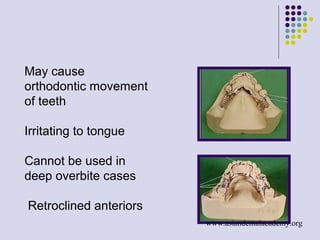 indirect retainers for Removable Partial Dentures | PPT