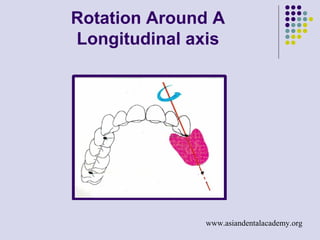 indirect retainers for Removable Partial Dentures | PPT | Dental Health ...