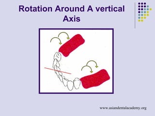 indirect retainers for Removable Partial Dentures | PPT | Dental Health ...