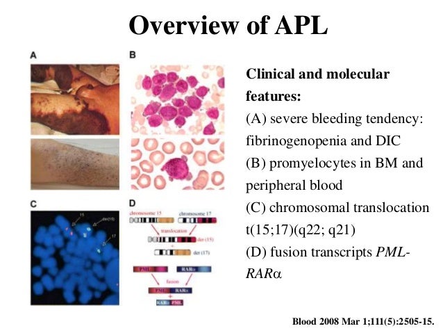Acute Promyelocytic Leukemia