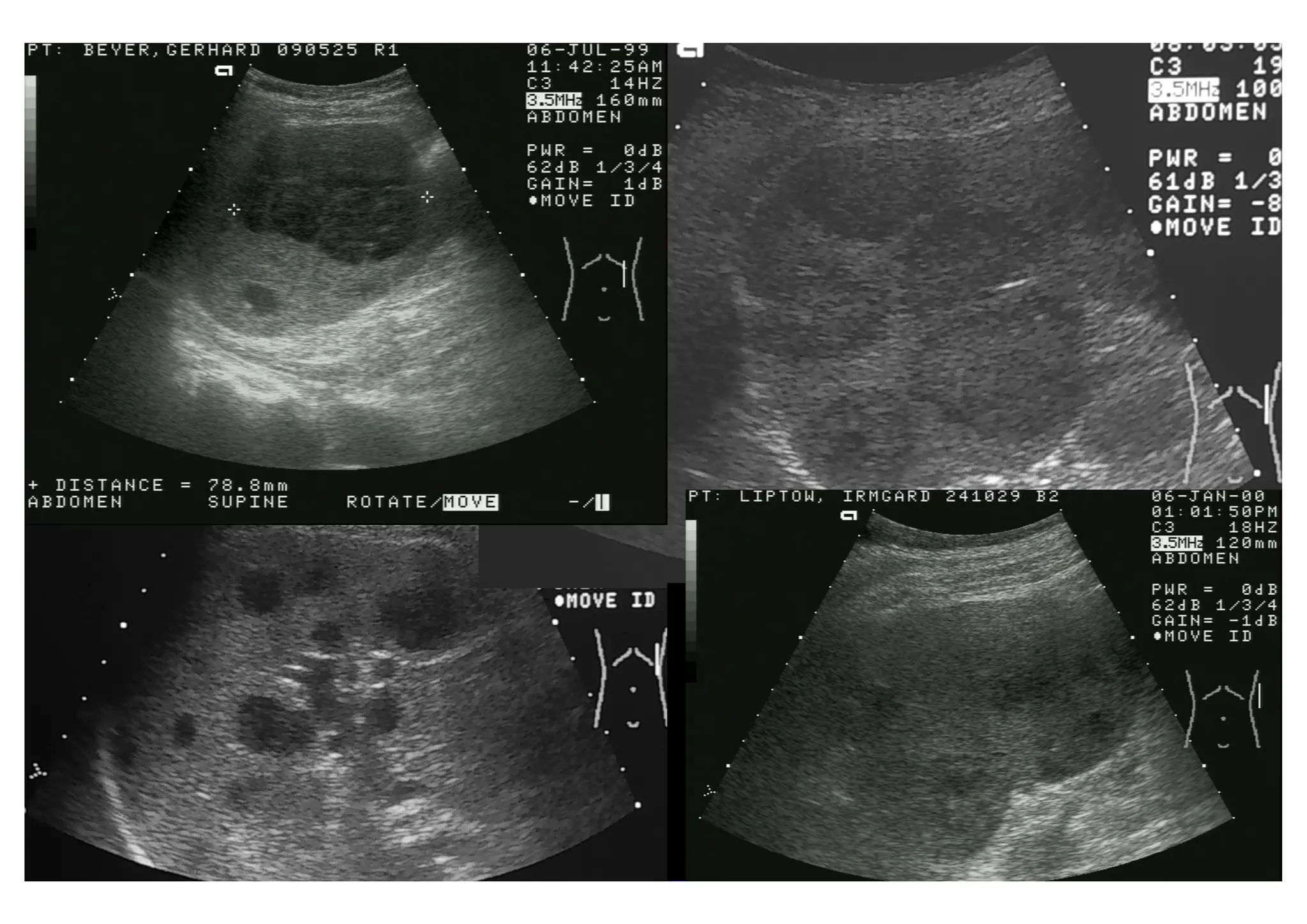 06 Sonographie der Milz. Lymphknotenveränderungen im Abdomen ...