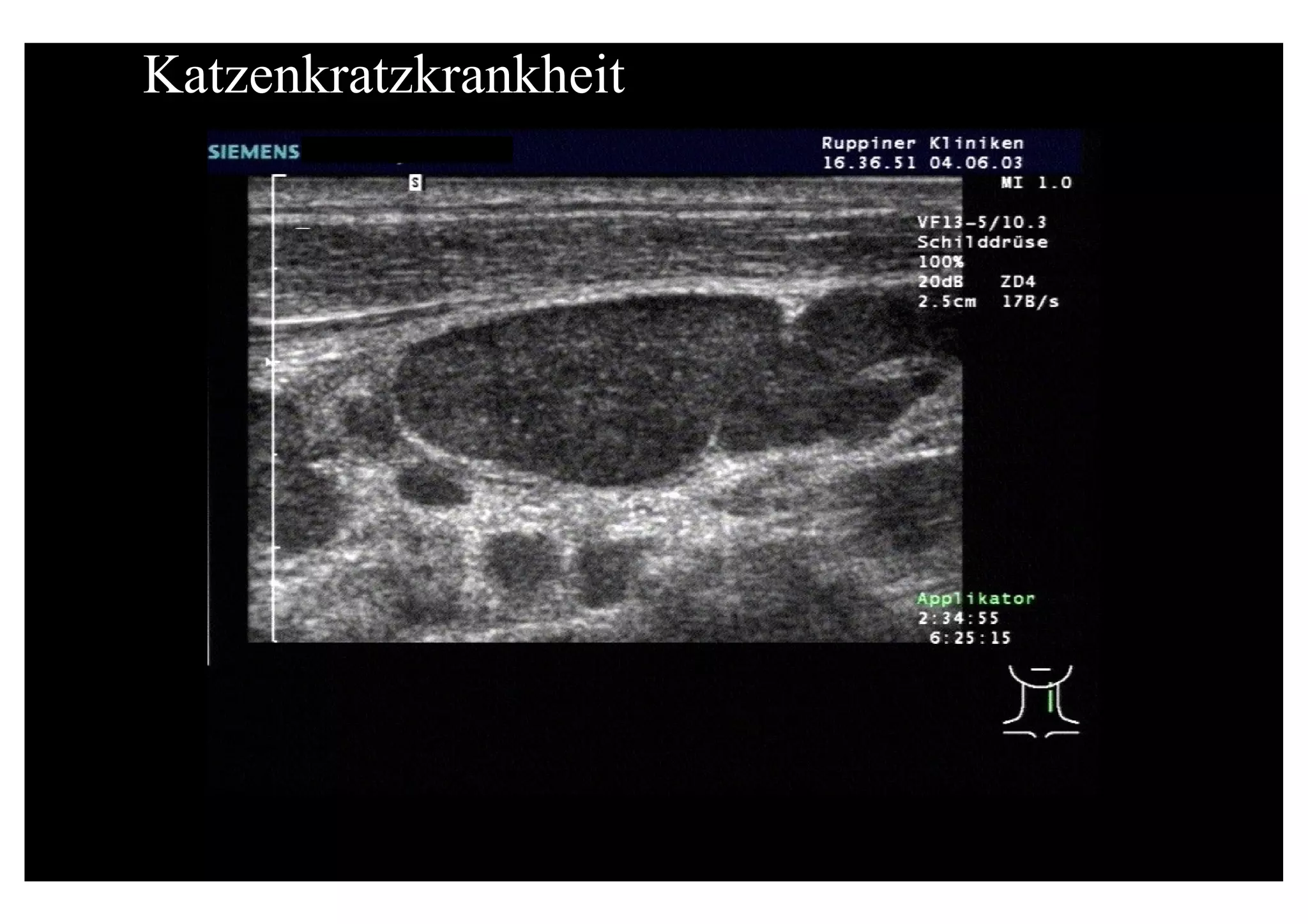 06 Sonographie der Milz. Lymphknotenveränderungen im Abdomen ...