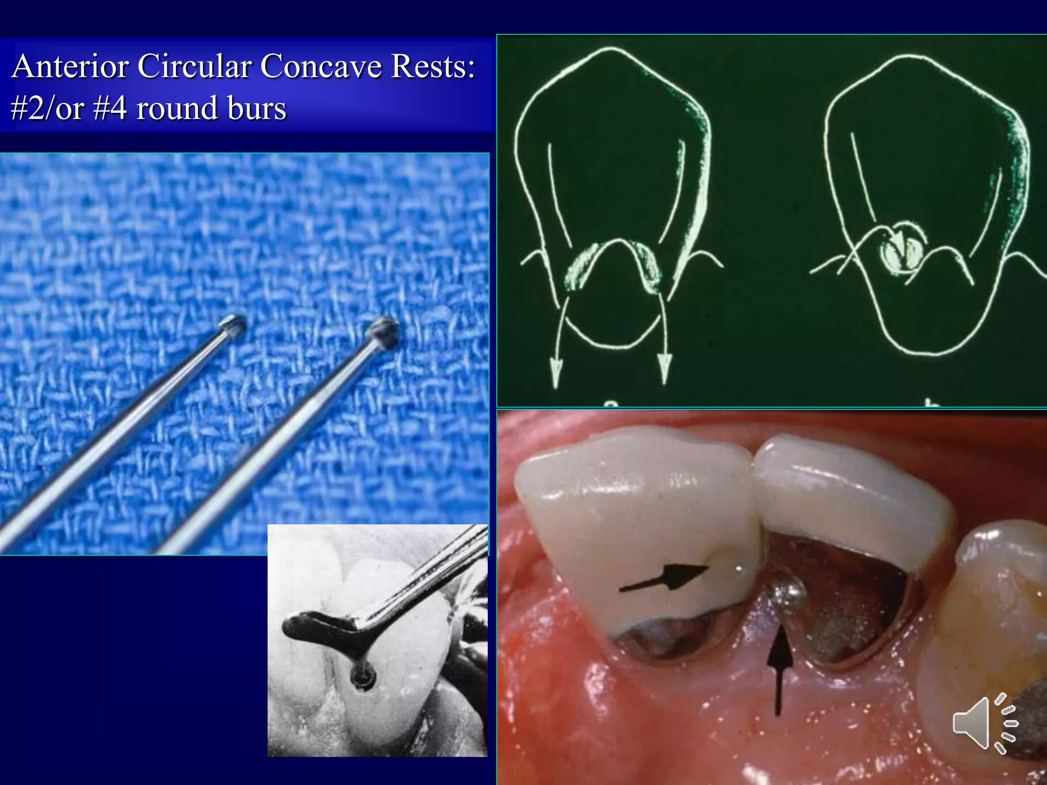 b- Types of tooth rests | PPT
