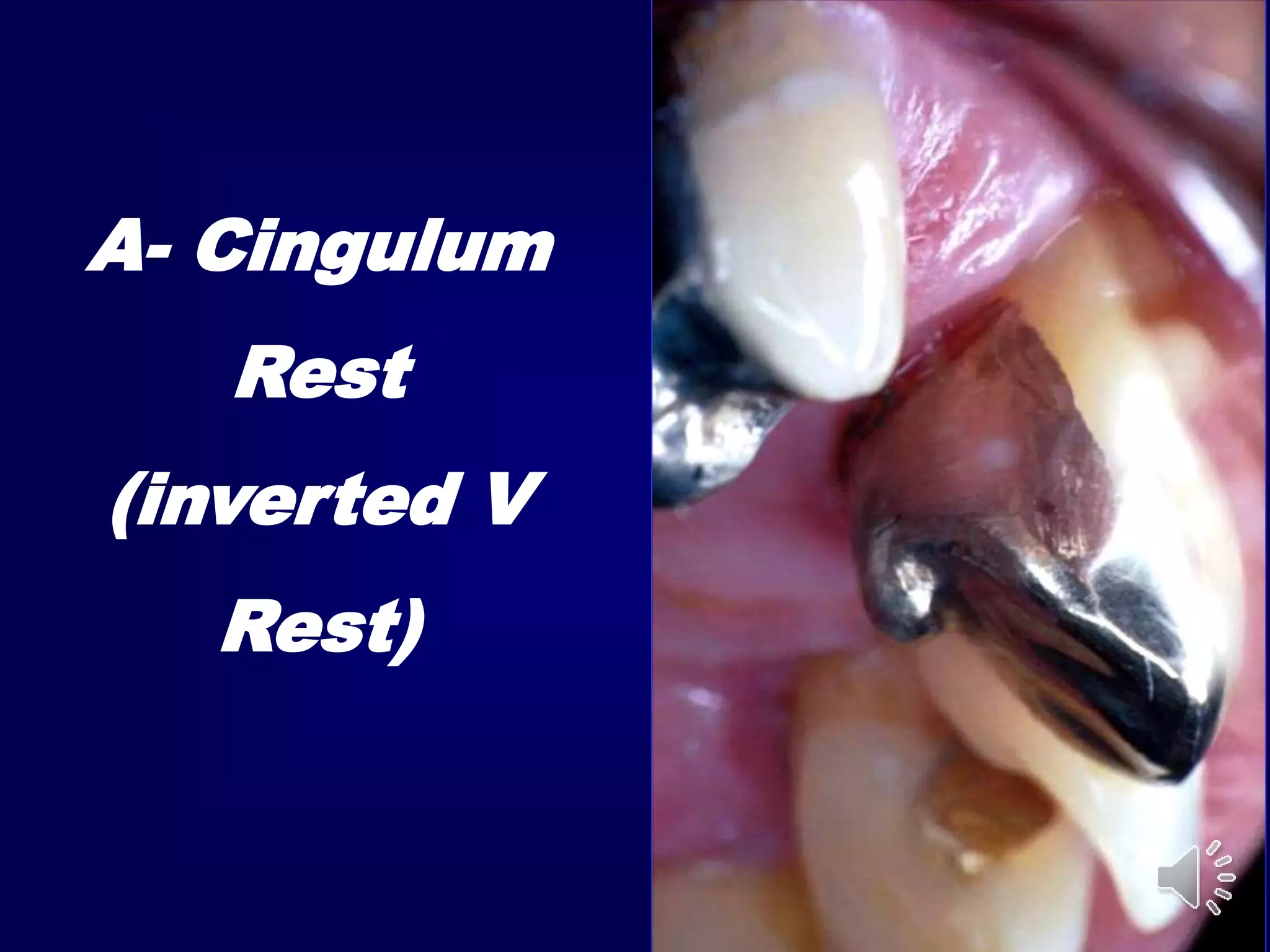 b- Types of tooth rests | PPT