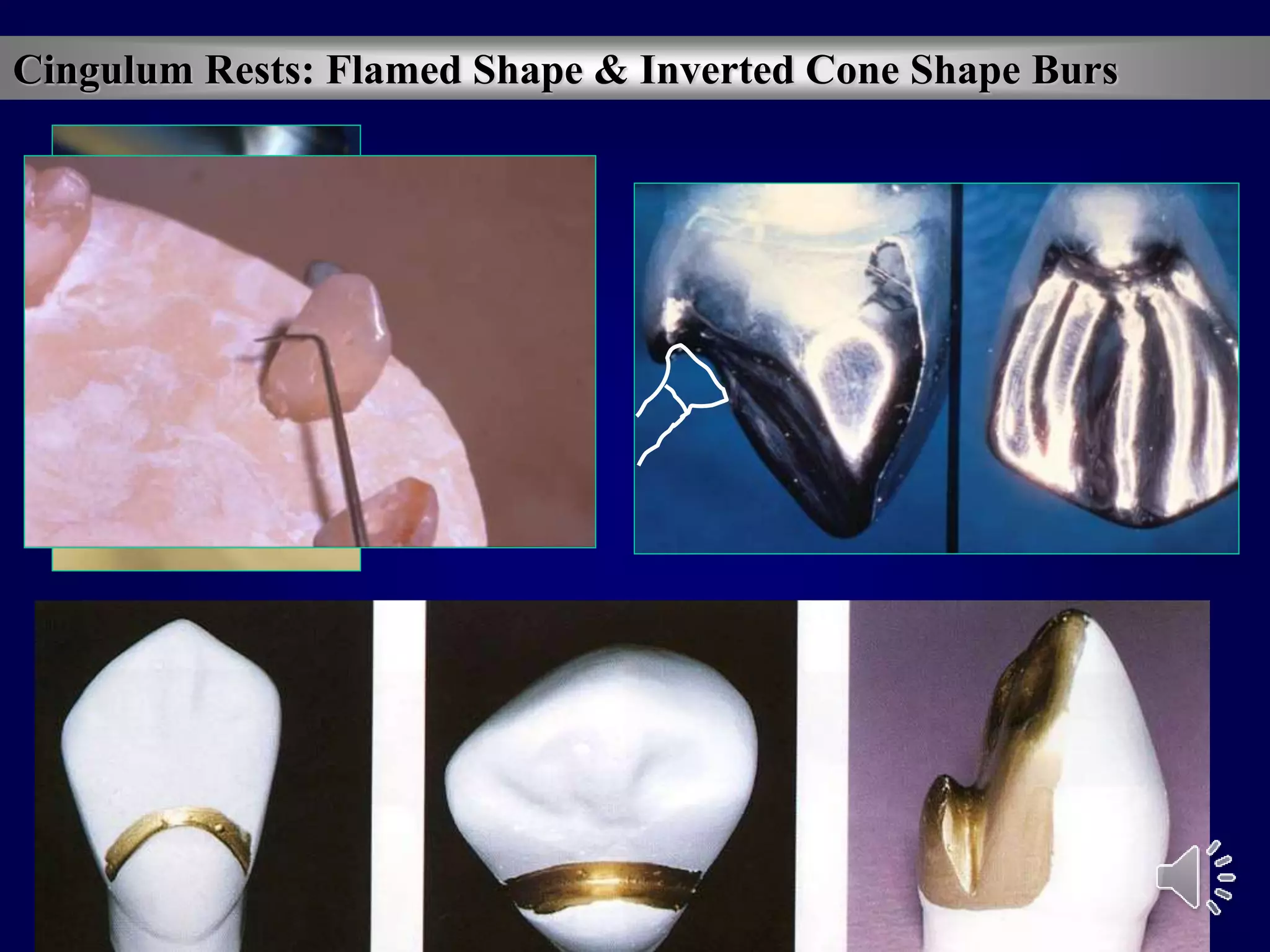 b- Types of tooth rests | PPT