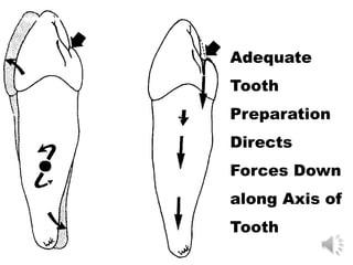 b- Types of tooth rests | PPT