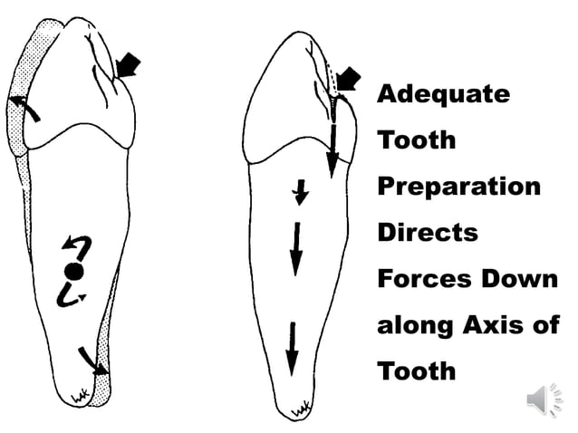 b- Types of tooth rests | PPT | Dental Health | Diseases and Conditions