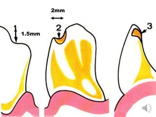 b- Types of tooth rests | PPT