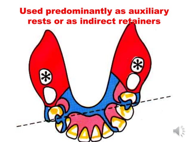 b- Types of tooth rests | PPT | Dental Health | Diseases and Conditions