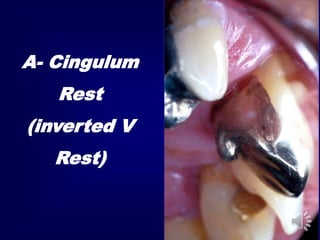 b- Types of tooth rests | PPT