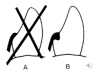 b- Types of tooth rests | PPT