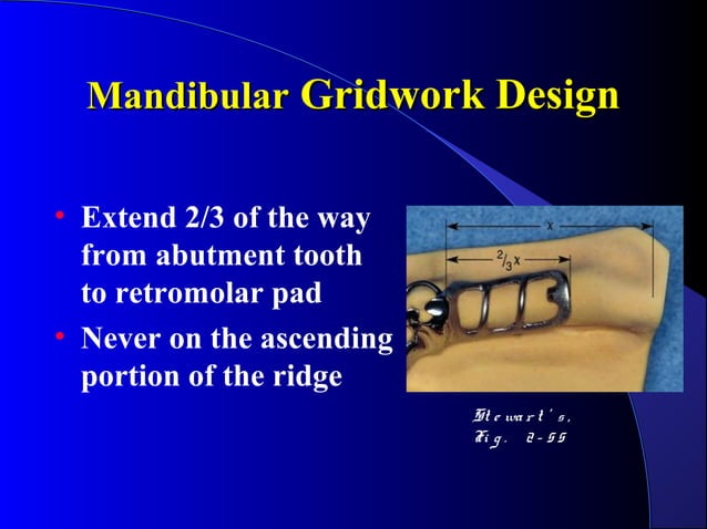 07 1. minor connectors | PPT | Dental Health | Diseases and Conditions