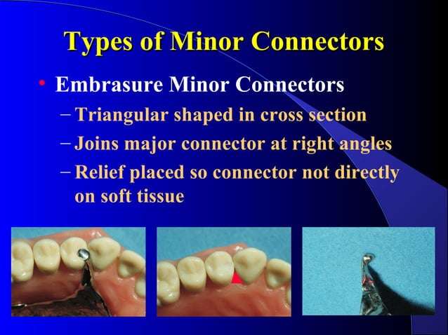 07 1. minor connectors | PPT | Dental Health | Diseases and Conditions