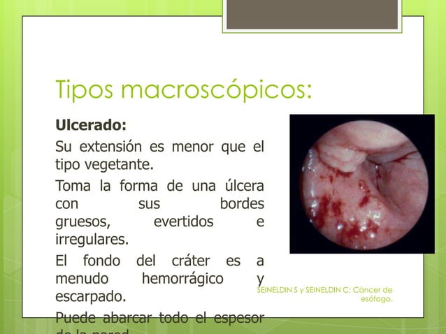 07.carcinoma de esofago y cardias