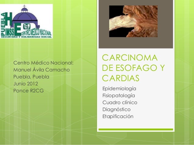 07.carcinoma de esofago y cardias