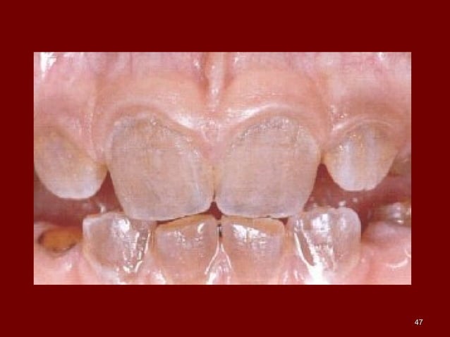 07.non carious lesions | PPT | Dental Health | Diseases and Conditions