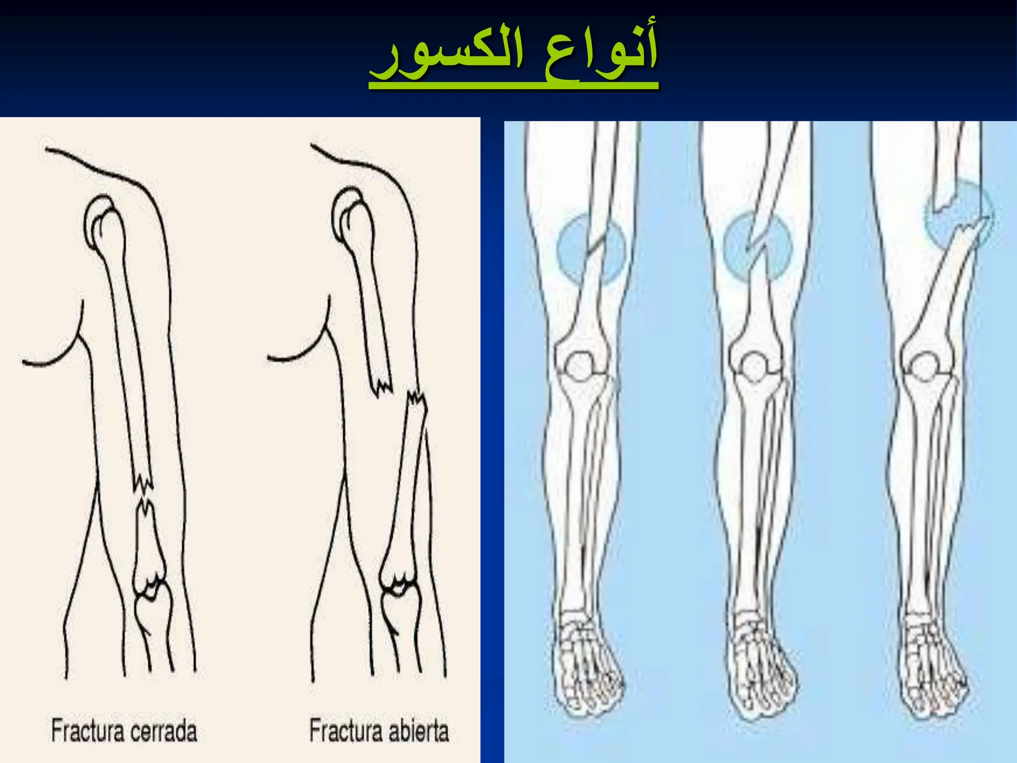 07- الكسور fracure for nursing College.ppt