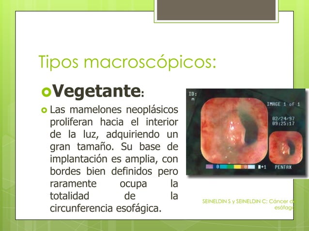 Carcinoma de Esofago y Cardias | PPT