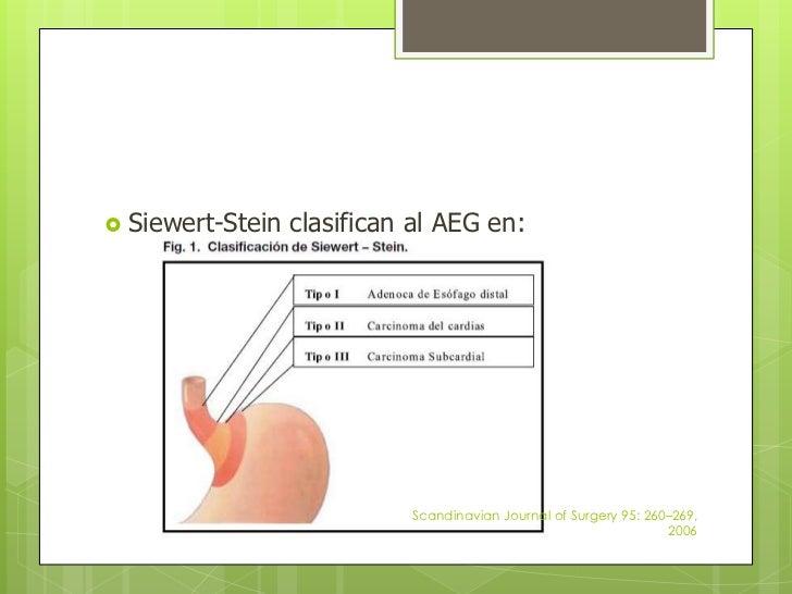 Carcinoma de Esofago y Cardias