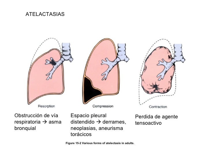 Atelectasis Diagram