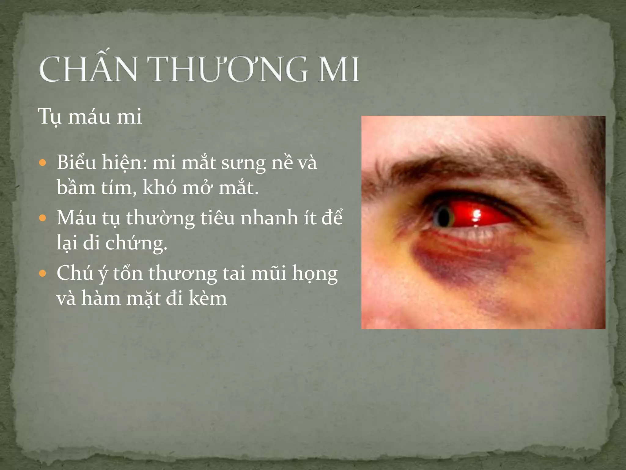 CHẤN THƯƠNG MẮT | PPTX