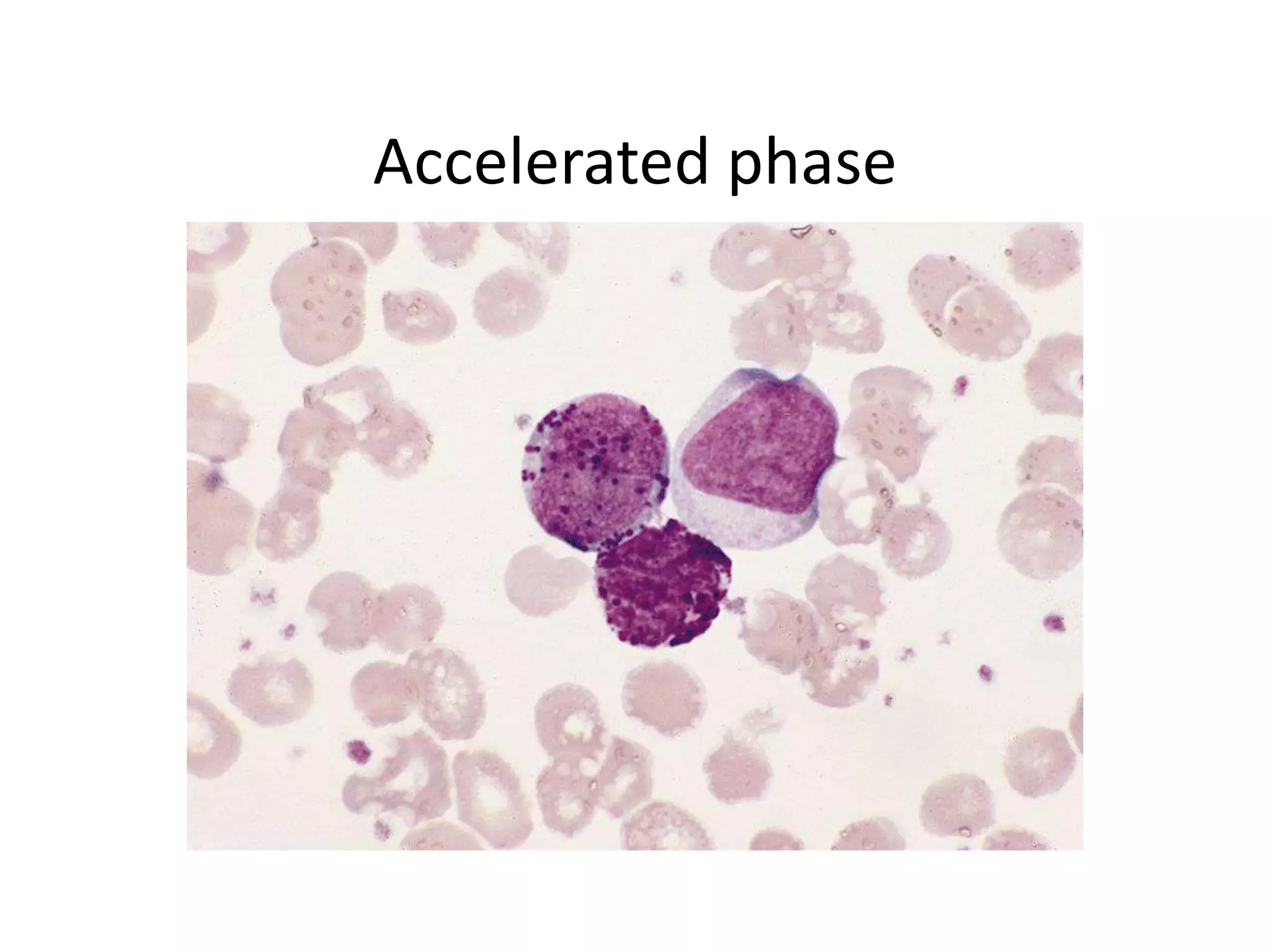 Chronic myeloid Leukemia | PPTX