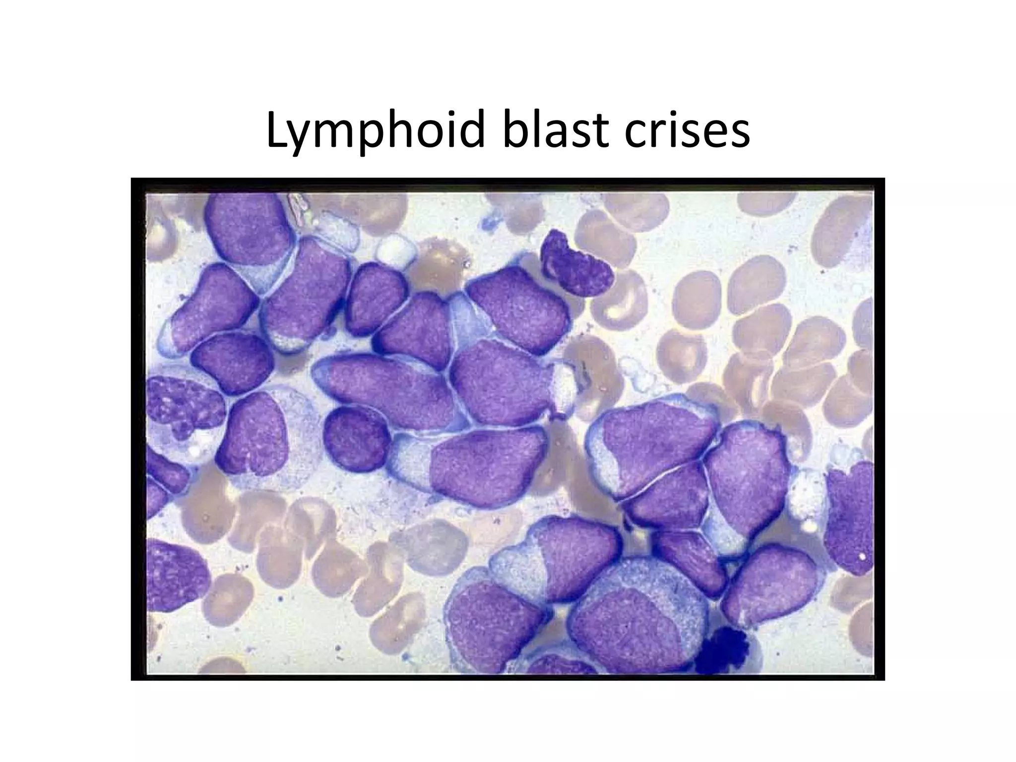 Chronic myeloid Leukemia | PPTX