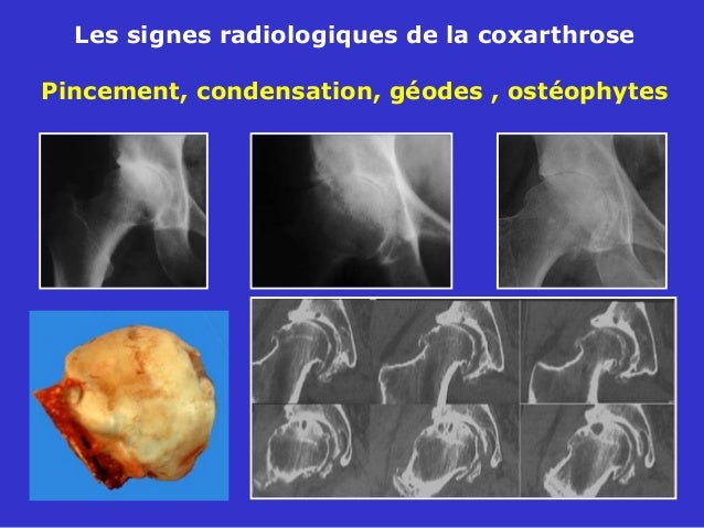 07 coxarthrose