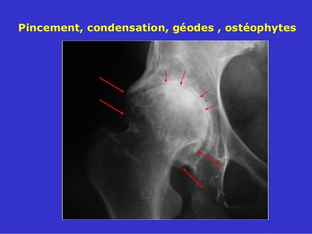 07 coxarthrose