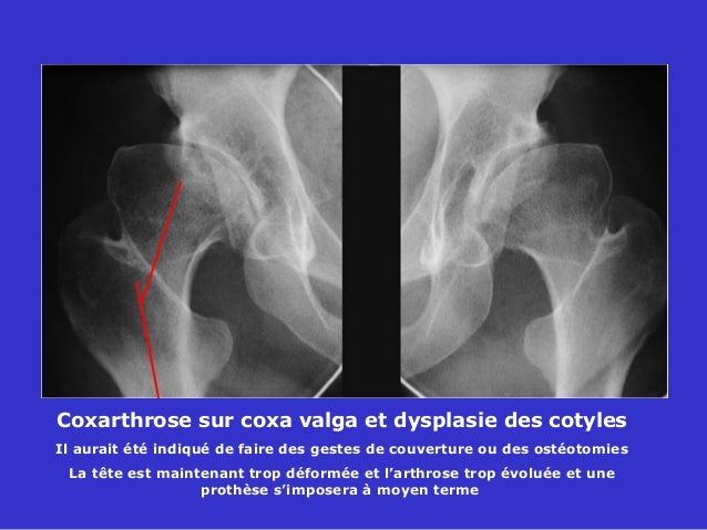 07 coxarthrose