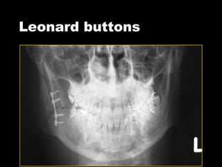 07 mandible, means of imf, imp vs hand holding | PPT