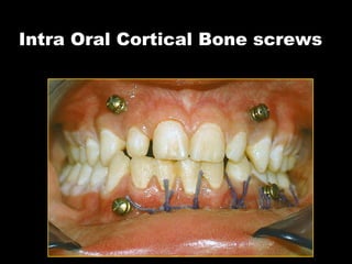 07 mandible, means of imf, imp vs hand holding | PPT