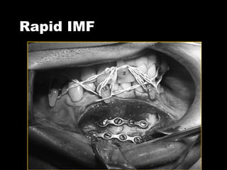 07 mandible, means of imf, imp vs hand holding | PPT