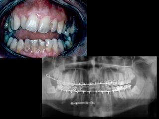 07 mandible, means of imf, imp vs hand holding | PPT